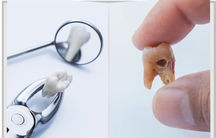 Wisdom Teeth Removal & Decay: Signs, Risks & Prevention | Diagnopein