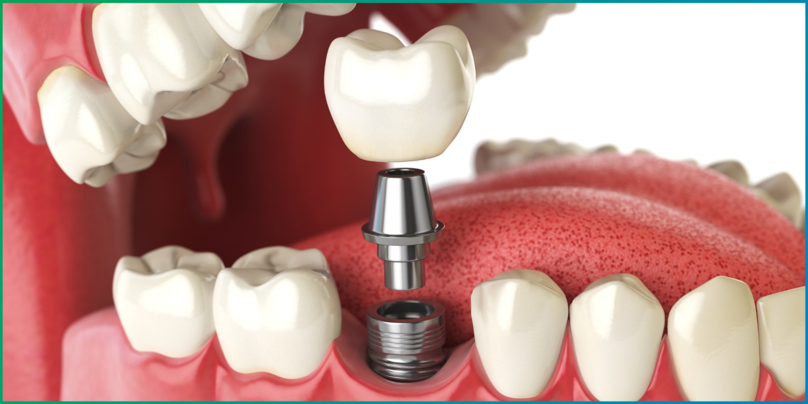 Dental Implants Treatment in Pune | Diagnopein Dental Clinic