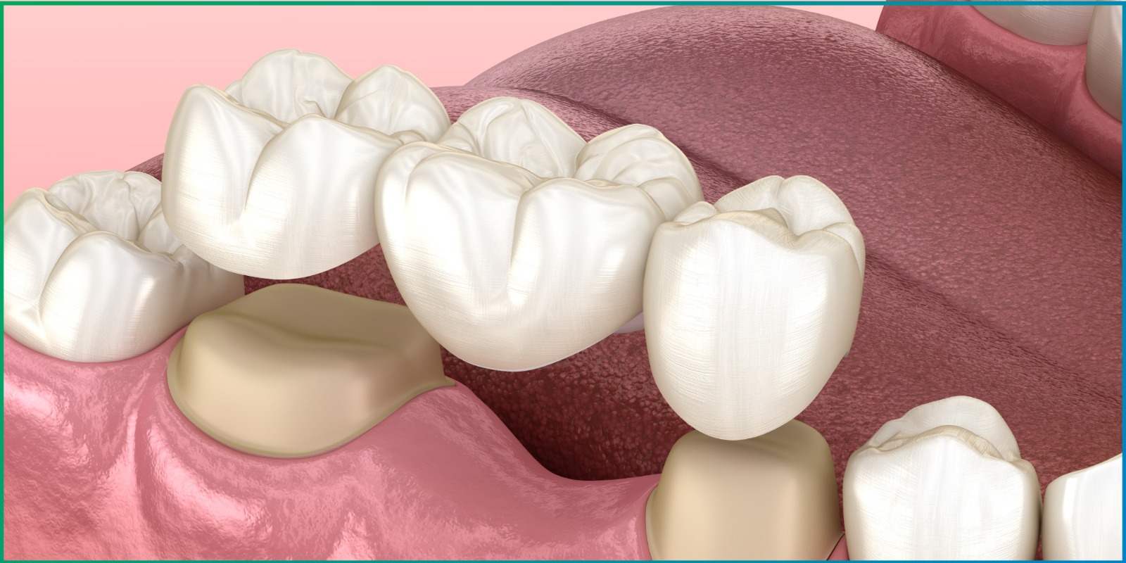 Dental Bridges Treatment in Mumbai | Diagnopein Dental Clinic