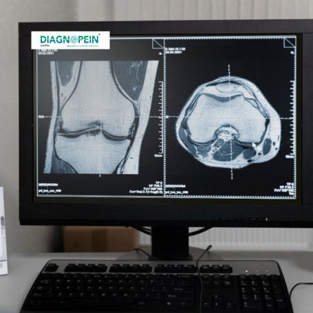 CT LT Humerus (Plain) – Purpose, Procedure, and Benefits