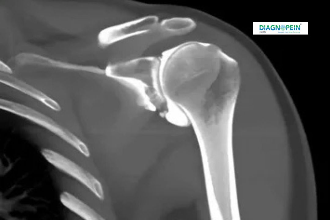 CT Shoulder Scan – Importance, Procedure, Benefits & Parameters ...