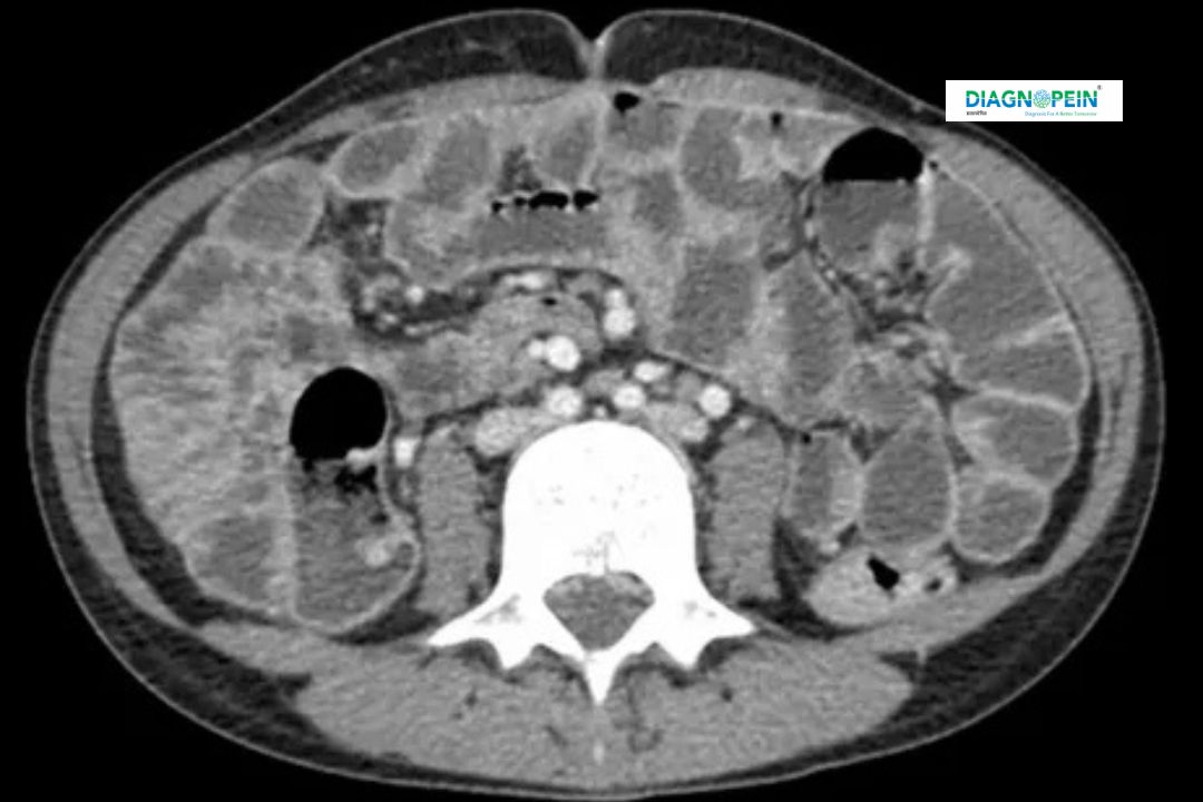 CT Enteroclysis Scan – Advanced Small Bowel Imaging for Accurate Diagnosis