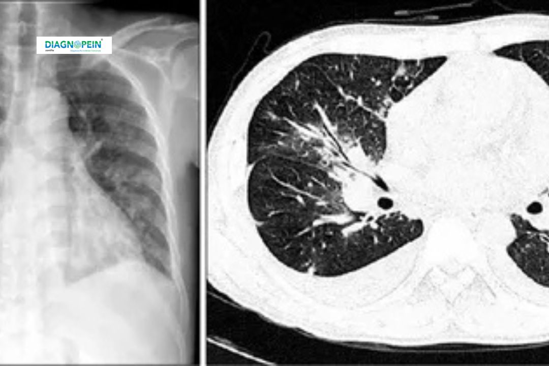 HRCT Chest Scan – High-Resolution CT Chest Test, Purpose, Benefits ...