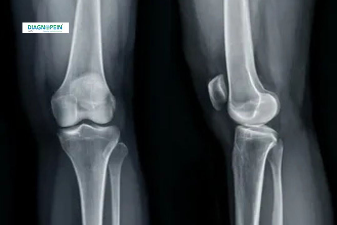 Left Knee Lateral View X-Ray | Procedure, Purpose, Benefits – Diagnopein