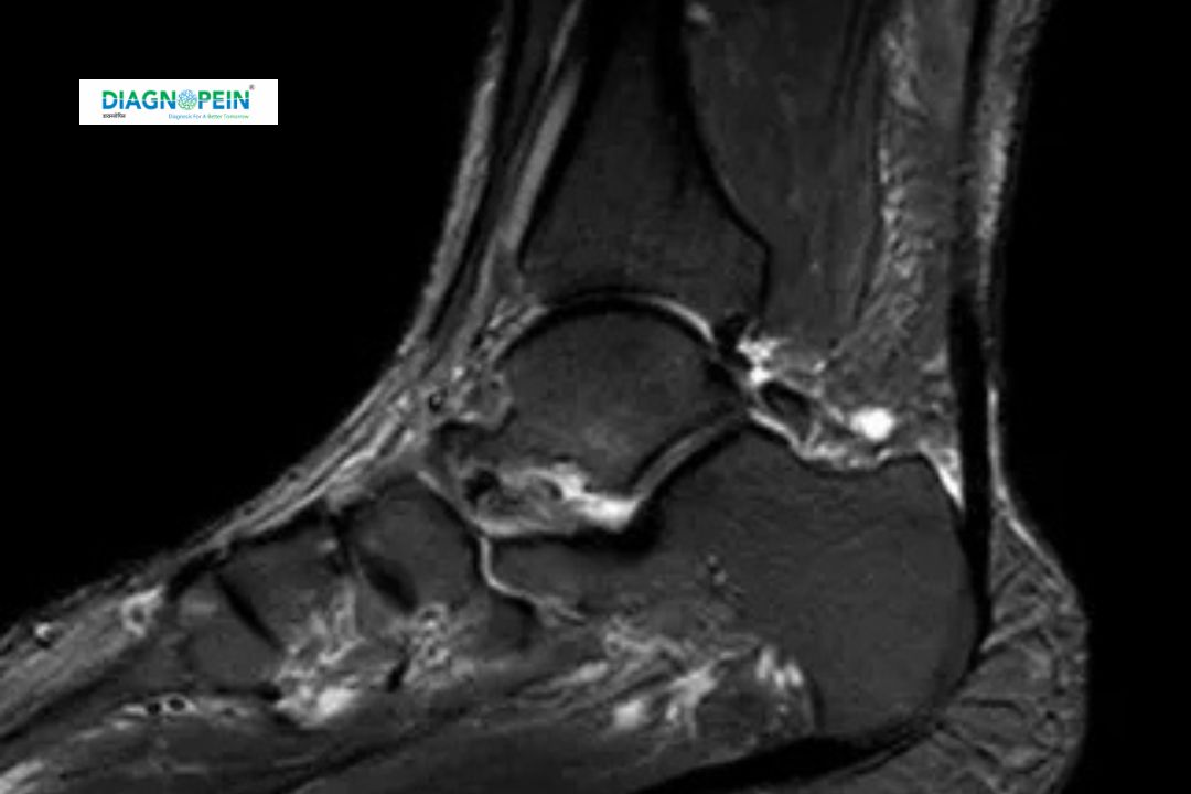MRI Ankle Both Joints with Contrast | Detailed Scan, Procedure ...