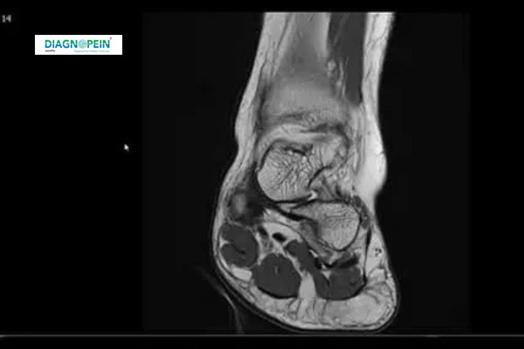 MRI Ankle Both Joints – Without Contrast | Bilateral Ankle MRI Test ...