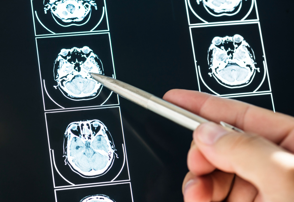 Best MRI Brain Veno | Advanced Venography Scan at Diagnopein