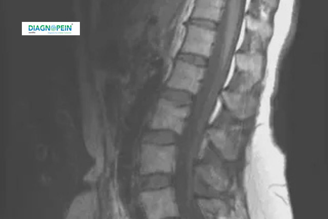 MRI Dorsal / Dorso Lumbar Spine – With Contrast | Diagnopein Radiology