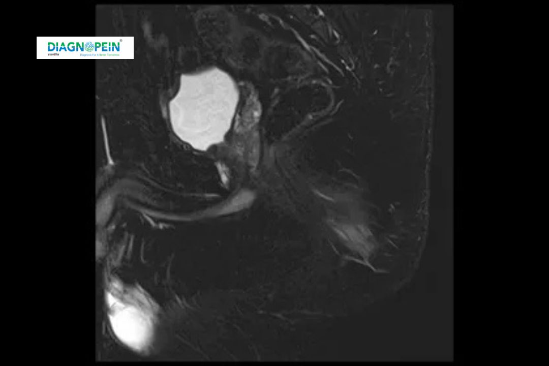 MRI Fistulagram Test – Accurate Fistula MRI Scan | Diagnopein