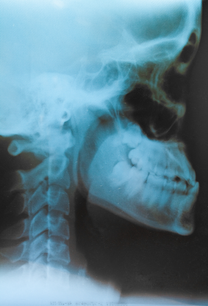 Skull AP & Lateral (2 Films) X-Ray – Overview, Procedure & Benefits