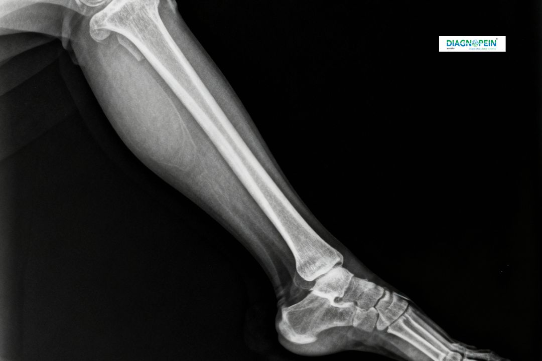 X-Ray Left Leg LAT View in Karad | Diagnopein Diagnostic Center