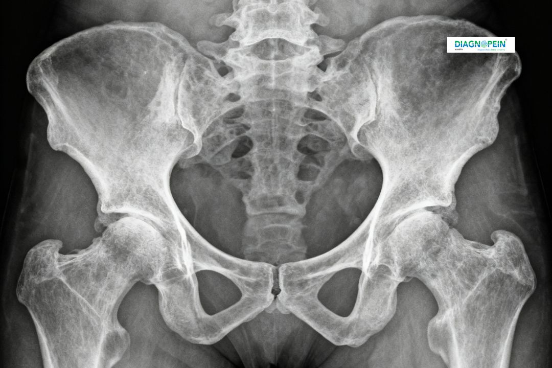 X-Ray Pelvis AP in Karad | Digital Pelvic X-Ray Test at Diagnopein