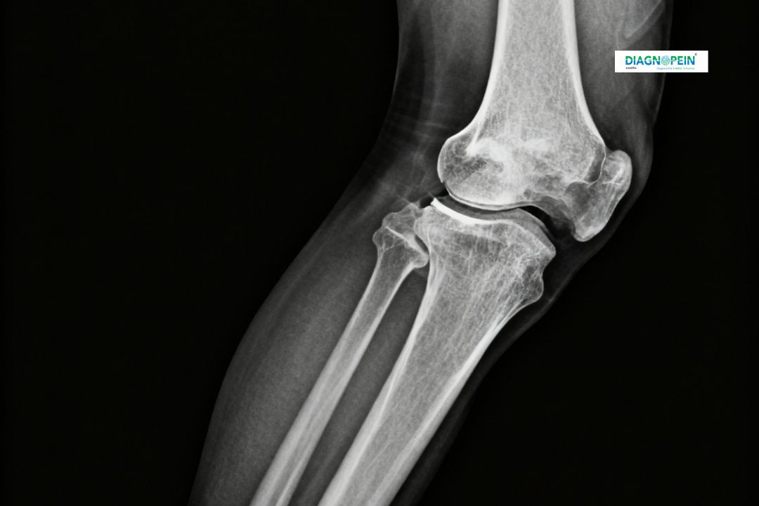 X-Ray Right Leg Lateral View in Karad | Diagnopein Imaging Center