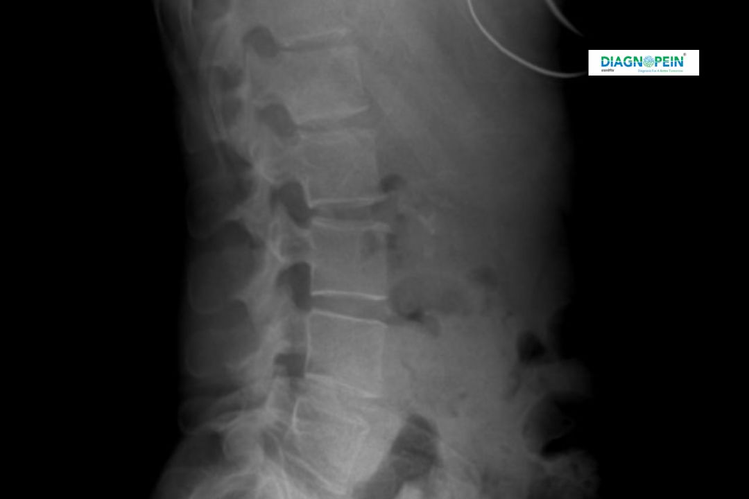 X-Ray Coccyx AP View in Karad | Diagnopein Diagnostic Center