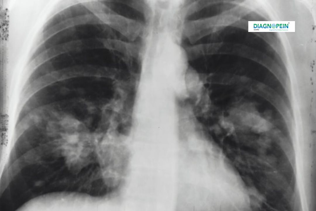 X-Ray Coccyx AP/LAT in Karad | Digital Tailbone X-Ray Test | Diagnopein