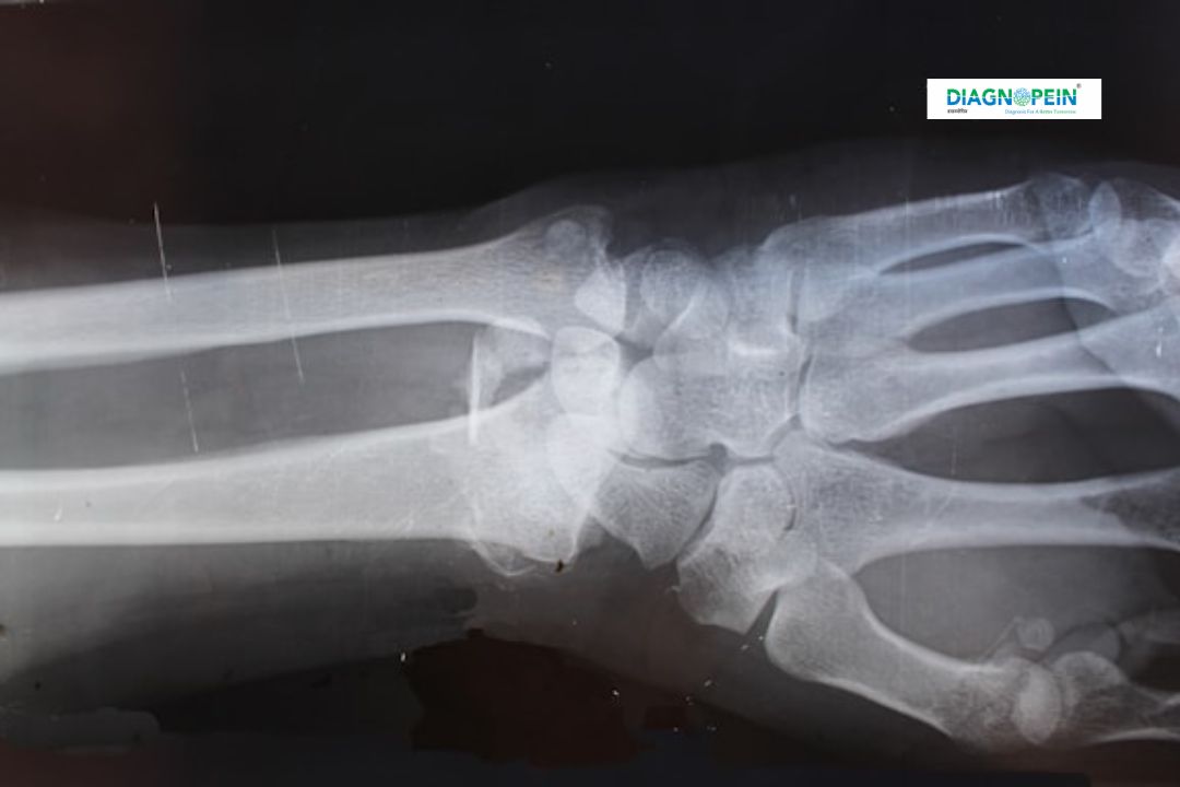 X-Ray Foot AP View in Karad | Digital X-Ray Test | Diagnopein Center