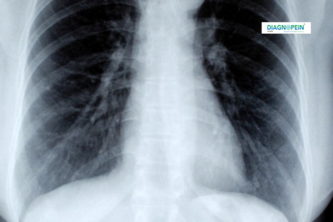 X-Ray KUB View in Karad | Abdomen X-Ray Test at Diagnopein