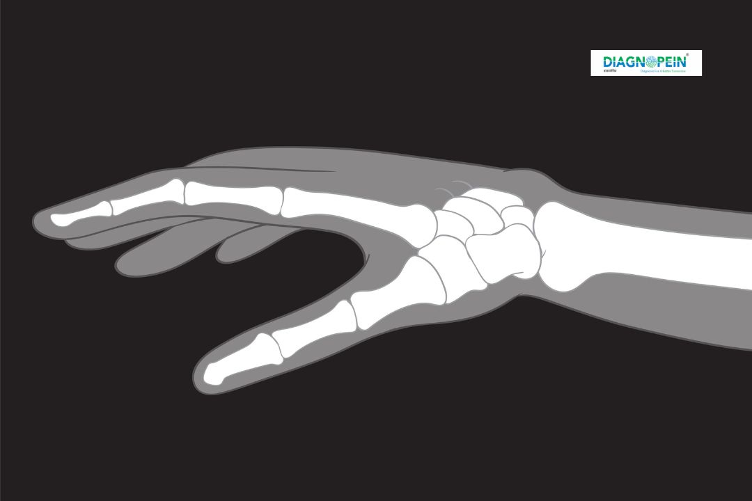 X-Ray Left Hand AP View in Karad | Procedure, Importance & Benefits ...