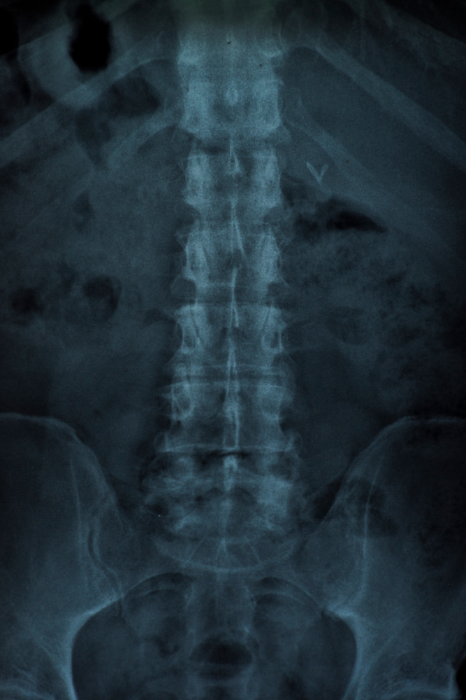 X-Ray Left Hip Lateral in Karad | Accurate Hip Joint Imaging - Diagnopein