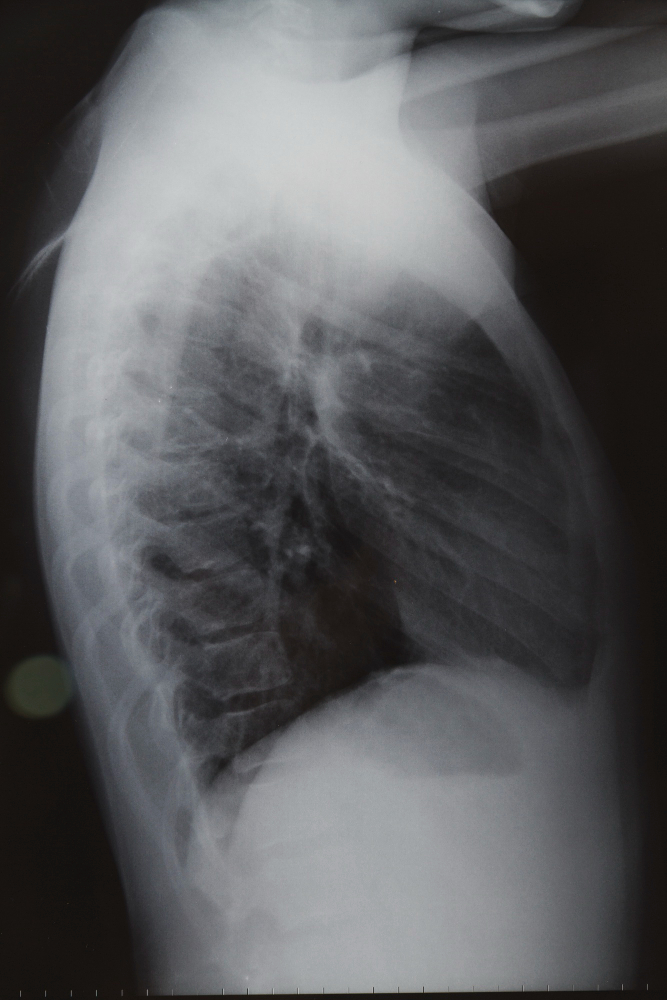 X-Ray Left Oblique Chest in Karad | Accurate Digital Chest X-Ray at ...