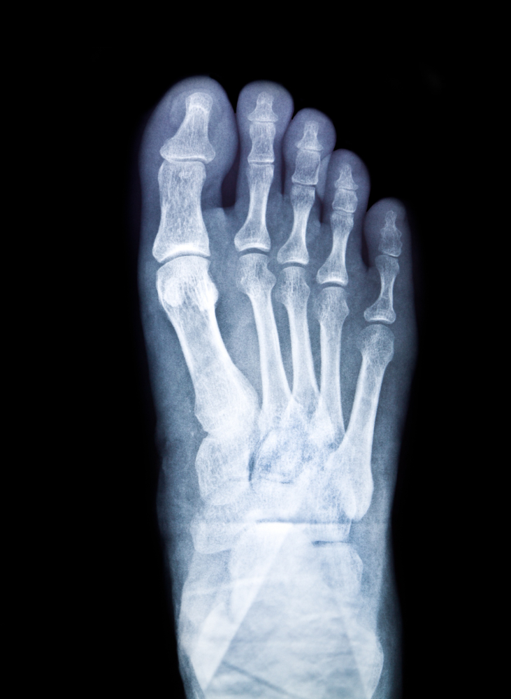 X-Ray Little Finger AP/LAT in Karad | Diagnostic Imaging at Diagnopein