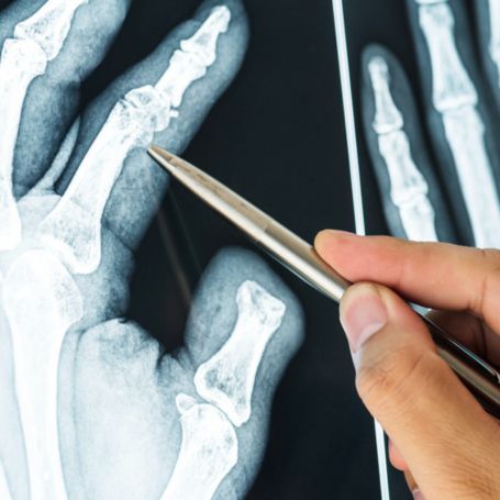 X-Ray Wrist Joint Scaphoid Oblique View in Karad | Diagnopein ...
