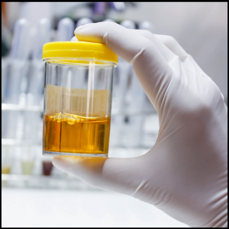 24 Hour Urine VMA Test in Pune | Diagnopein