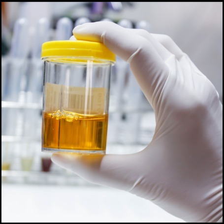 Urine Eosinophils Test in Mumbai | Diagnopein